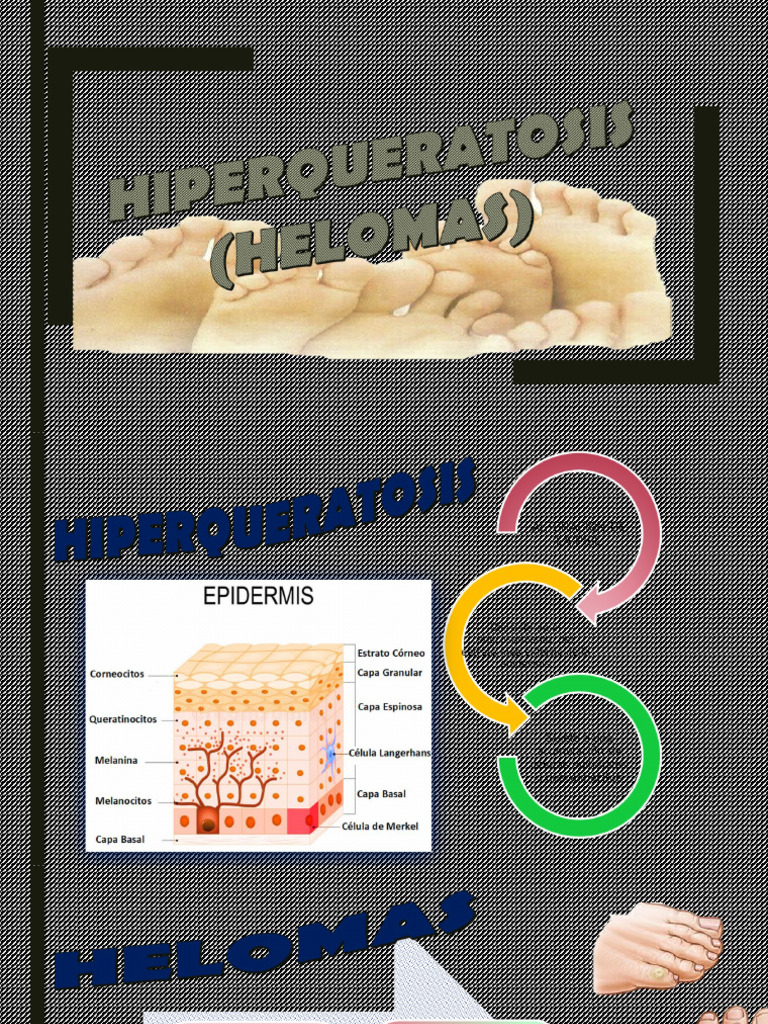 Hiperqueratosis | PDF