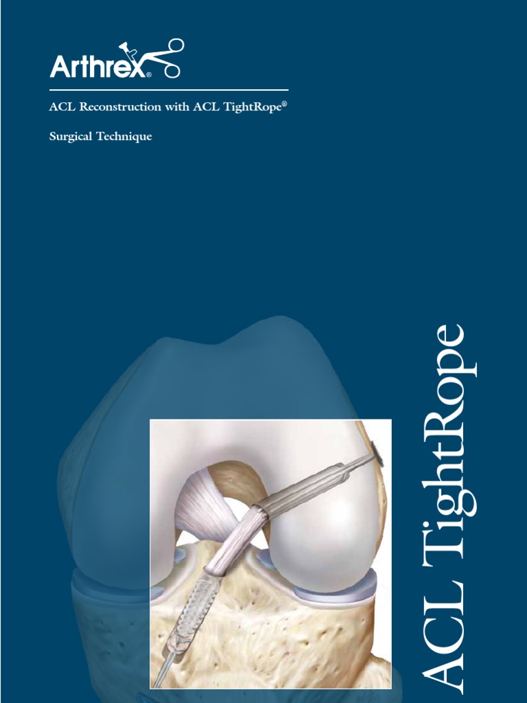ACL TightRope Brochure | Download Free PDF | Musculoskeletal System ...