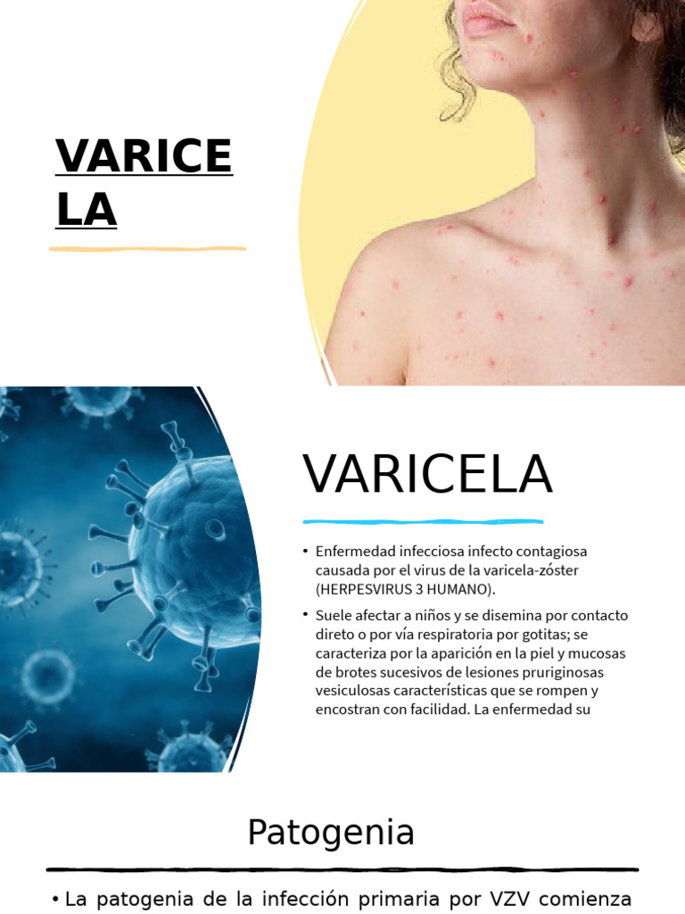 VARICELA | PDF