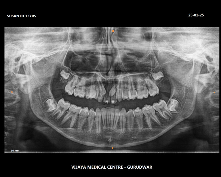 SUSANTH 13YRS OPG | PDF