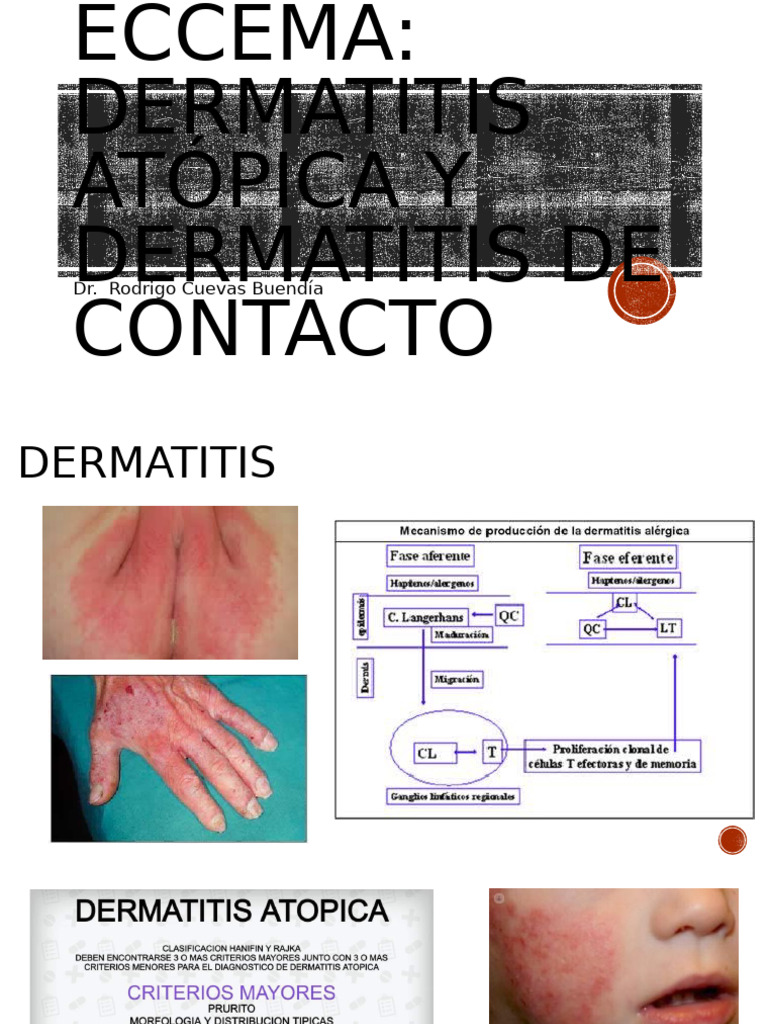 Dermatitis de Contacto | PDF