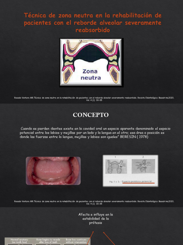 Técnica de Zona Neutra en La Rehabilitación de | PDF | Odontología