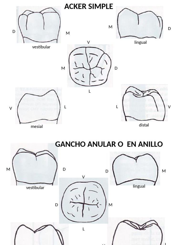 Tipos de Ganchos Acker en Ortodoncia | PDF