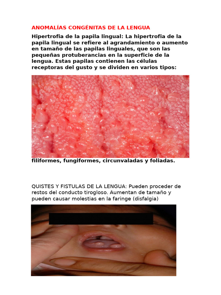 Anomalías Congénitas de La Lengua | PDF