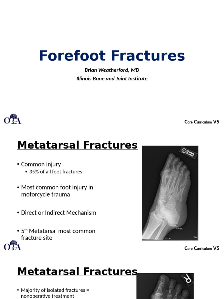 Jones Fracture Overview by Weatherford | PDF | Foot | Limbs (Anatomy)
