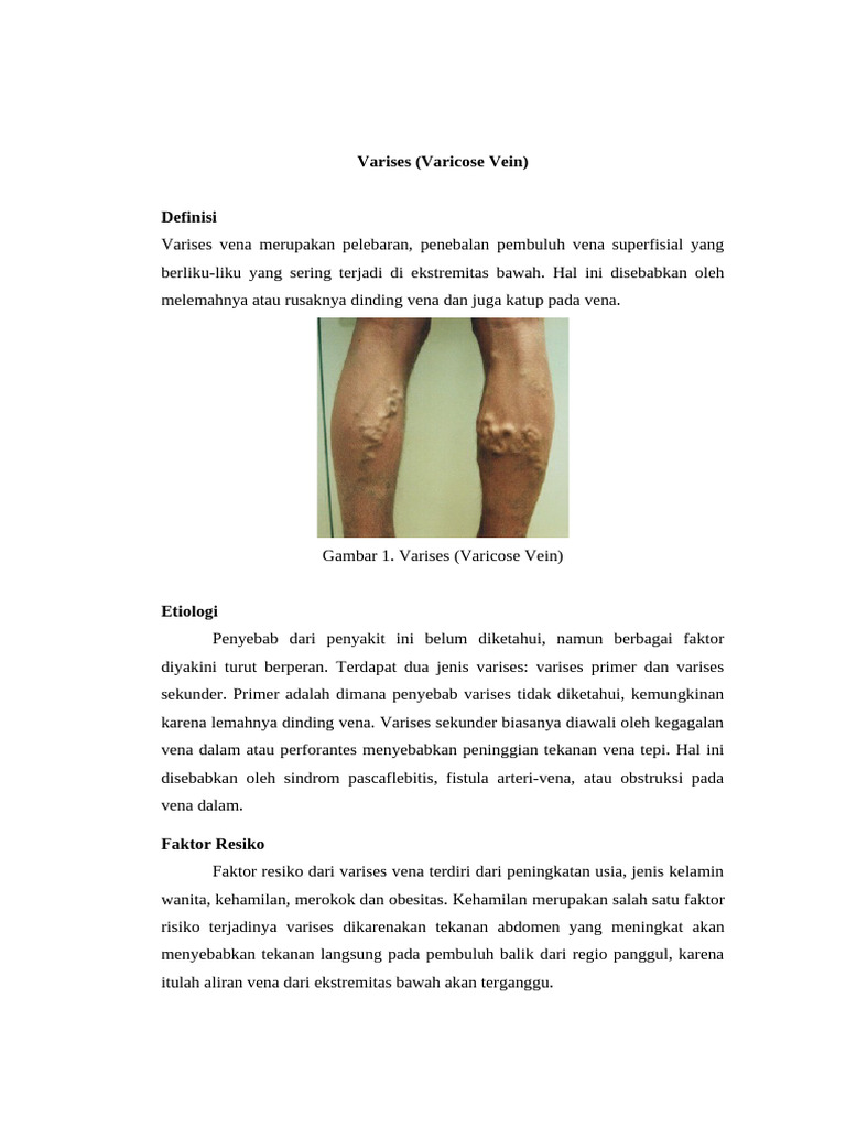 Phlebectomy untuk Varises Vena | PDF