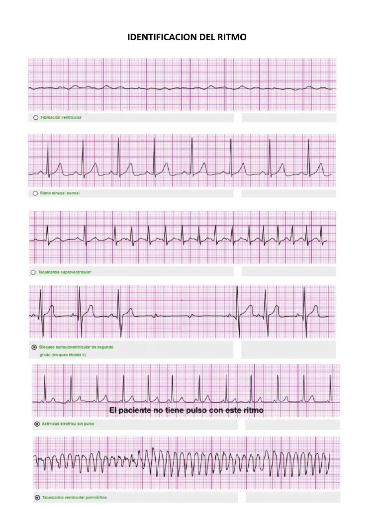 Ejemplos de Trazos Ecg | PDF