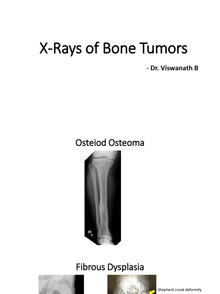 X-Rays of Bone Tumors - PPTX - Dr. Viswanath B | PDF