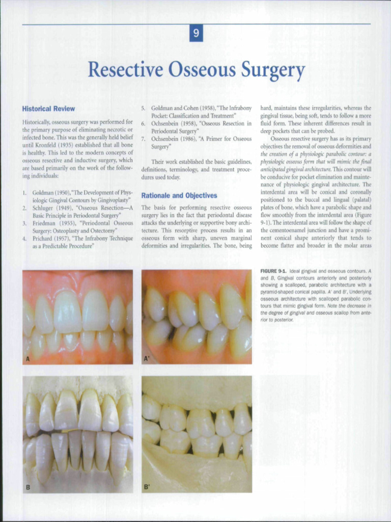 Resective Osseous Surgery | PDF | Periodontology | Dentistry