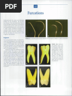 Furcation Involvement Management Guide | PDF | Periodontology | Mouth