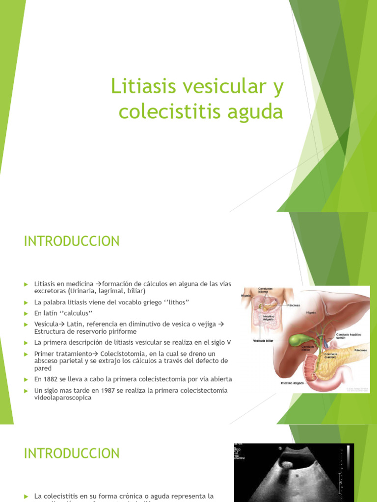 Litiasis Biliar y Colecistitis | PDF | Bilis | Vesícula biliar