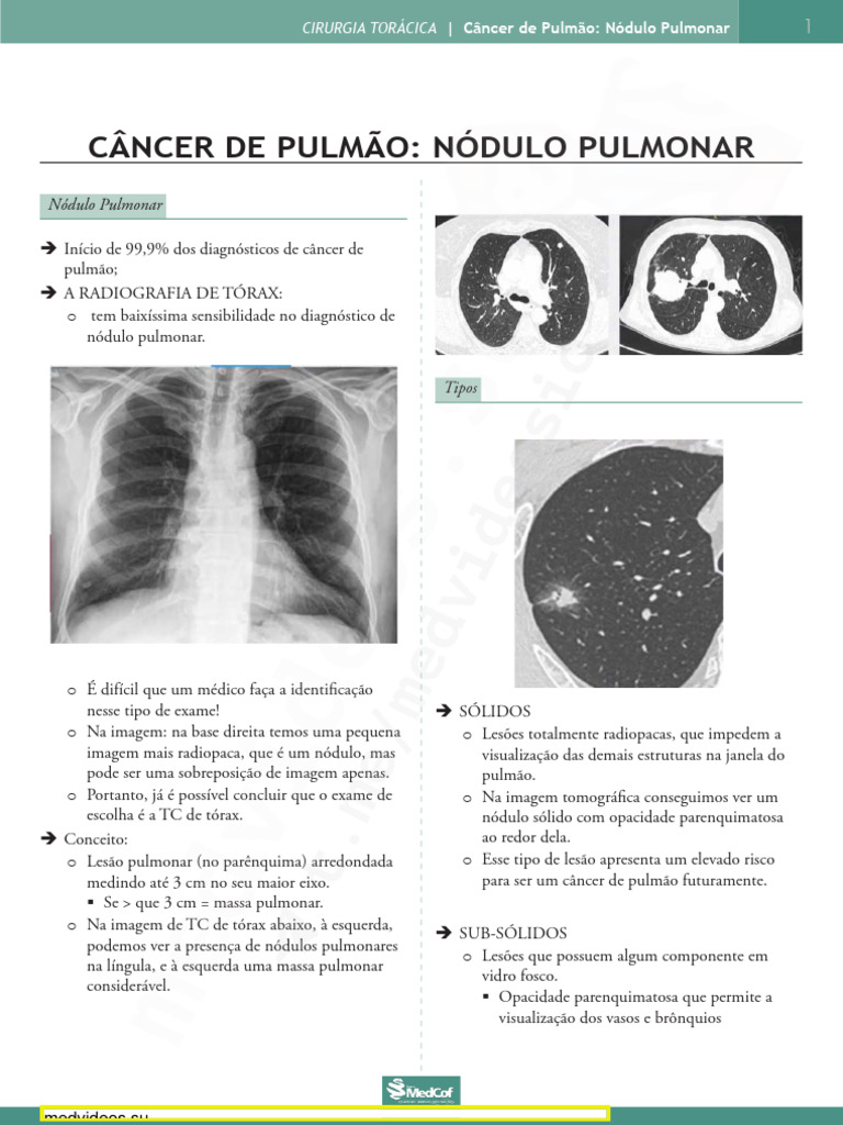 Diagnóstico de Nódulo Pulmonar | PDF | Câncer de pulmão | Câncer