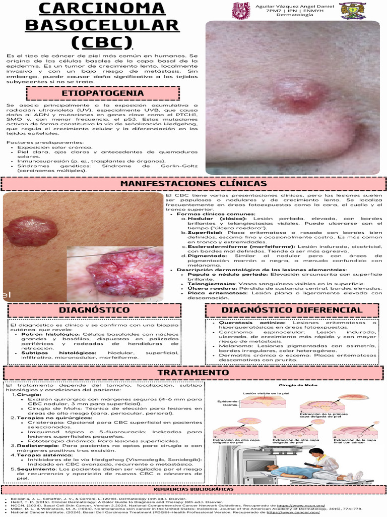 Carcinoma Basocelular Aguilar Angel Dermatología 7PM7 | PDF ...