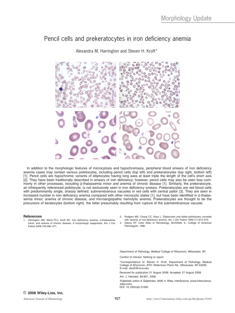 Pencil Cells in Iron Deficiency Anemia | PDF | Anemia | Hematology