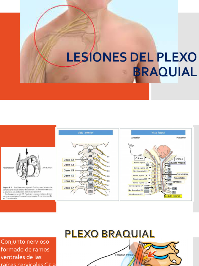 Lesiones Del Plexo Braquial | PDF | Nervio | Médula espinal