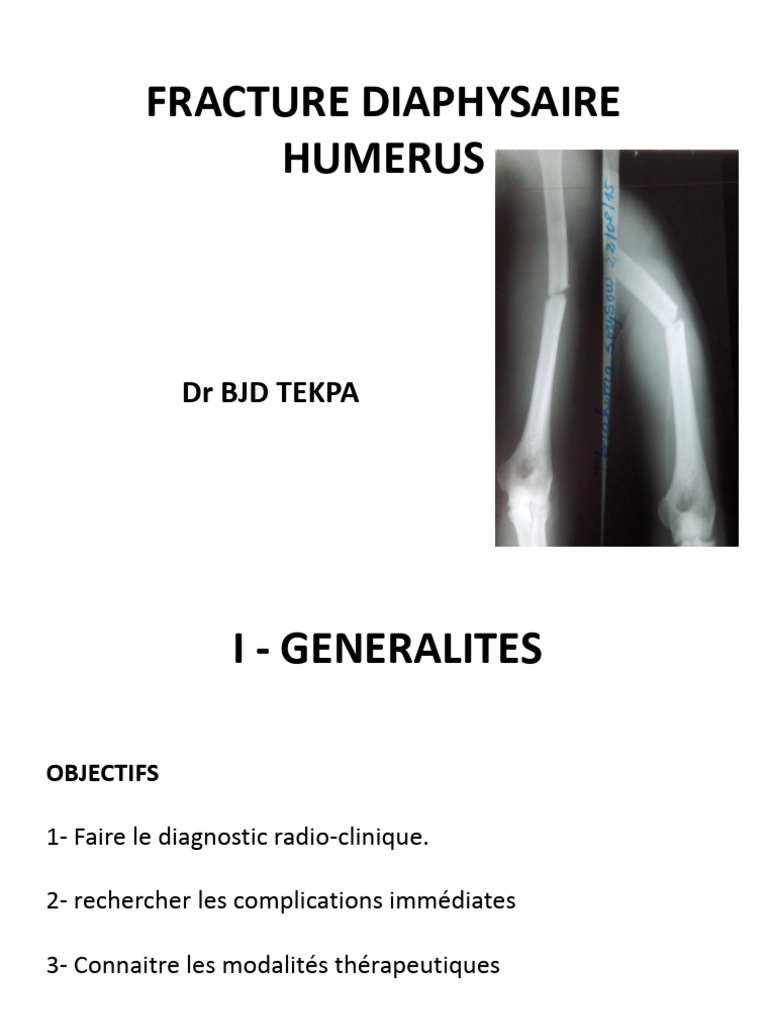 Fracture diaphysaire de l'humérus | PDF | Spécialités médicales ...