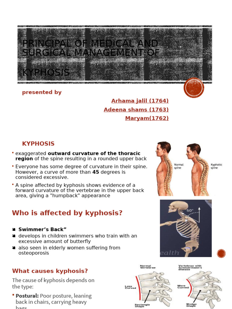 Kyphosis Presentation | PDF | Vertebral Column | Medical Specialties
