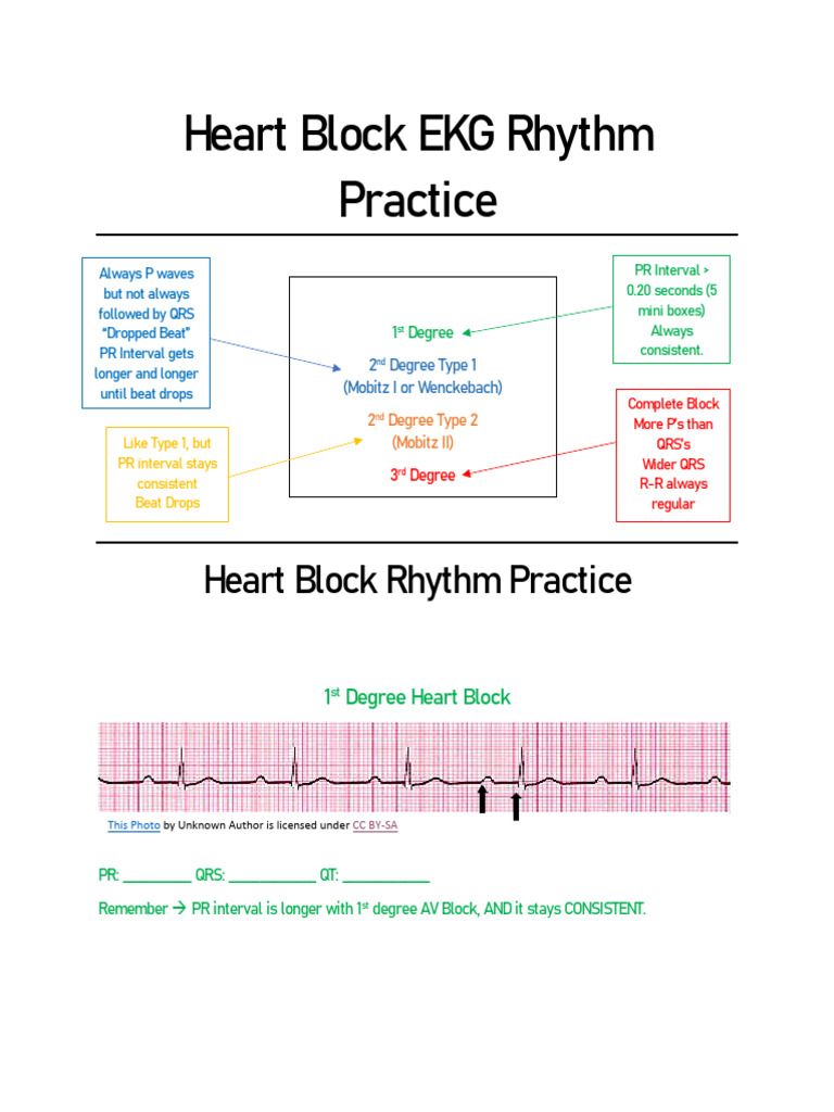 3 - EKG Heart Block Study Guide | PDF