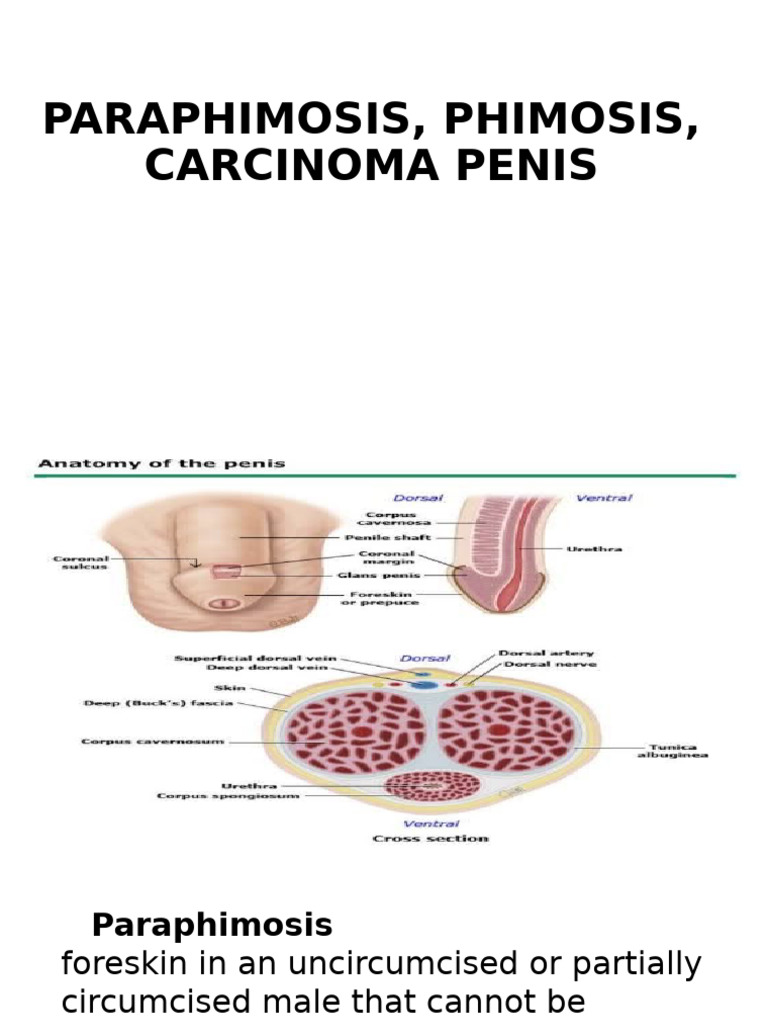 Phimosis, Paraphimosis, Carcinoma Penis | PDF | Medical Specialties ...