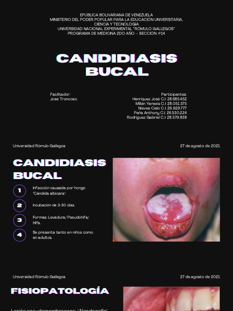 Candidiasis Bucal: Diagnóstico y Tratamiento | PDF | Candidiasis | Medicina