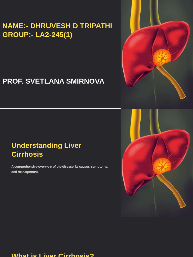 Understanding Liver Cirrhosis | PDF | Cirrhosis | Hepatitis