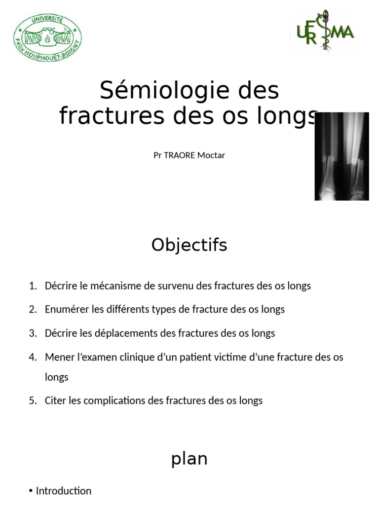 Fractures des os longs : mécanismes et types | PDF | Os | Orthopédie