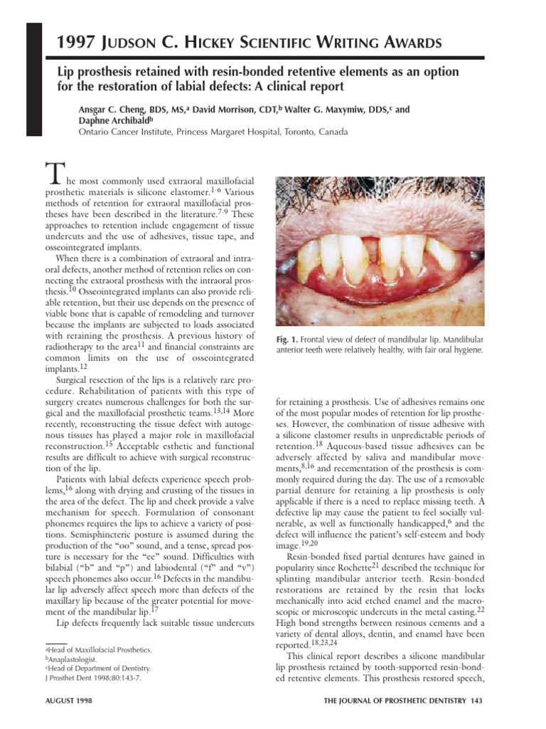 Lip Prosthesis with Resin-Bond Retention | PDF | Dental Implant ...
