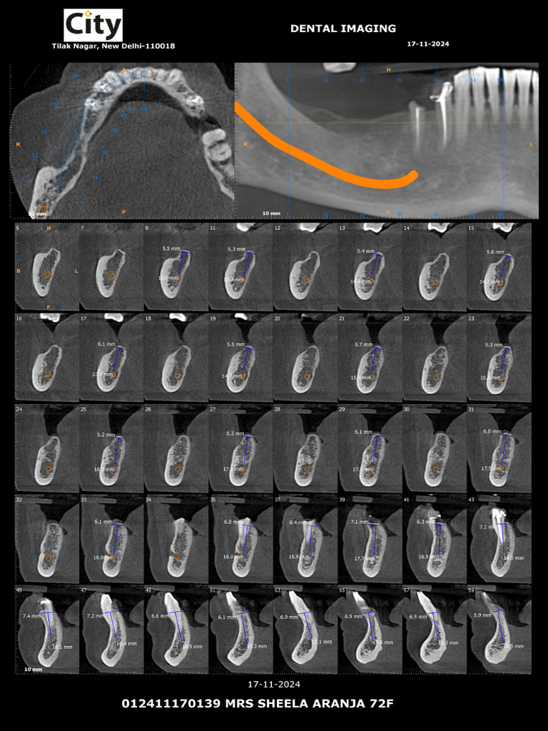 RT Mandible Cross - Section-1 | PDF
