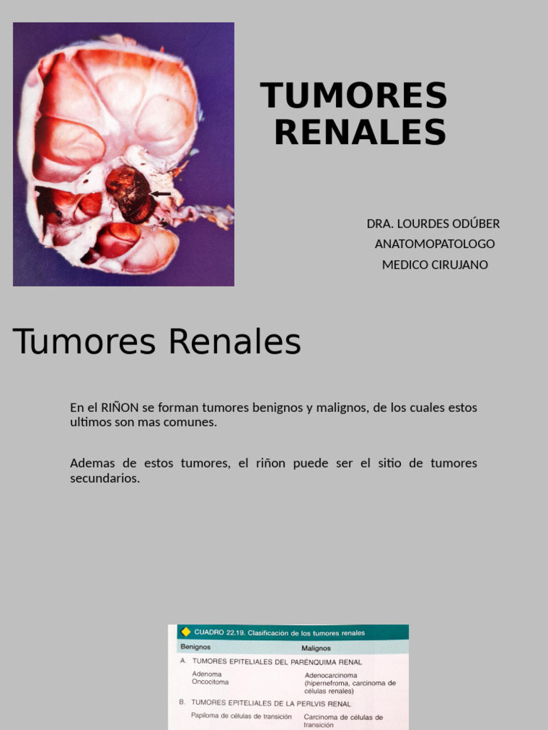 Tumores Renales: Tipos y Características | PDF | Neoplasias | Riñón