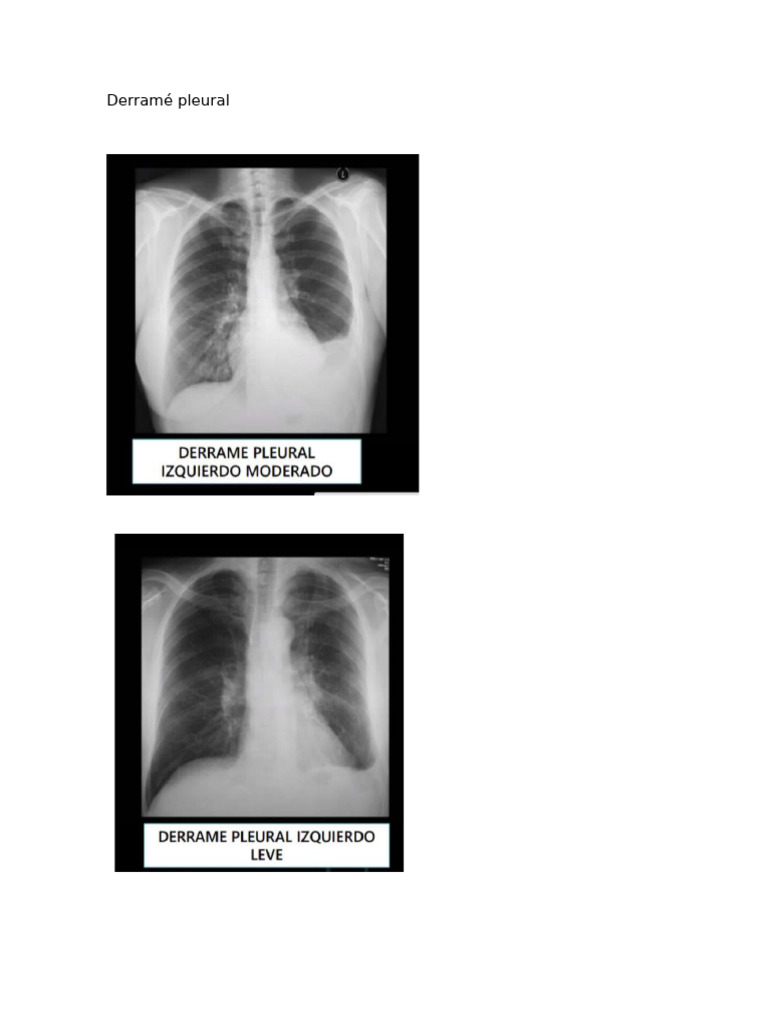 Imagenes RX de Derrame Pleural | PDF
