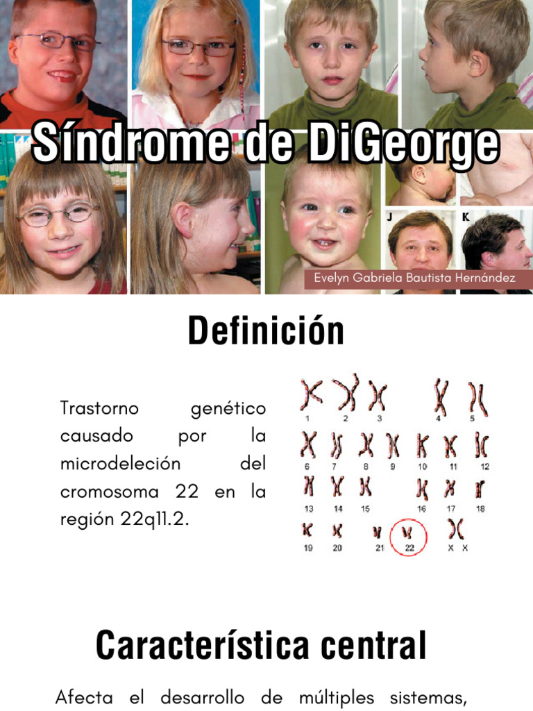 Síndrome De Digeorge Causas Y Tratamiento Pdf Autoinmunidad