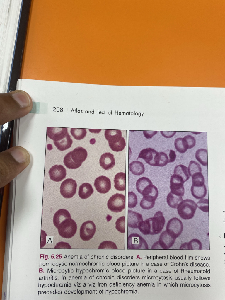 Anemia Pdf