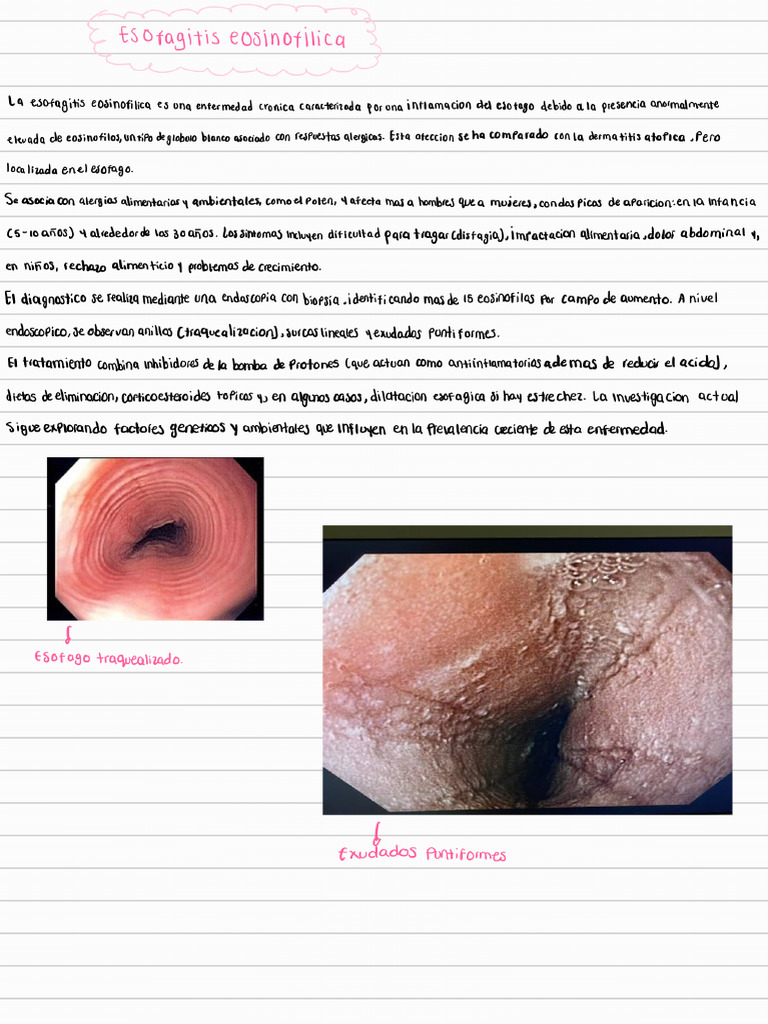 Esofágitis Eosinofílica | PDF