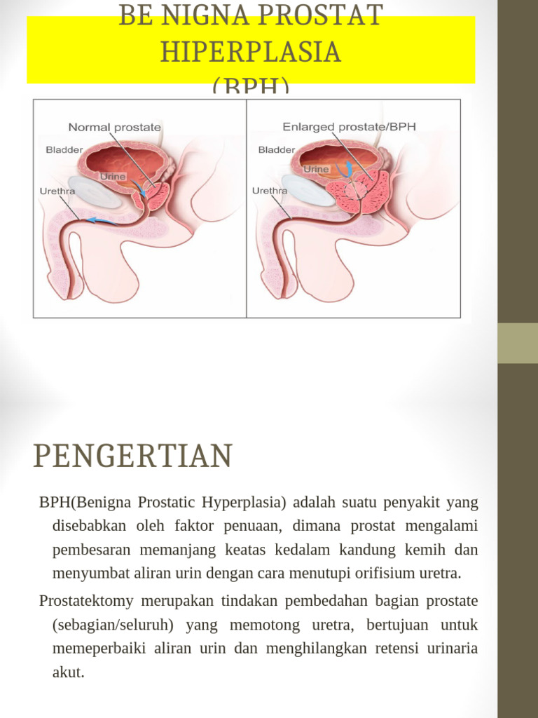PPT BPH | PDF