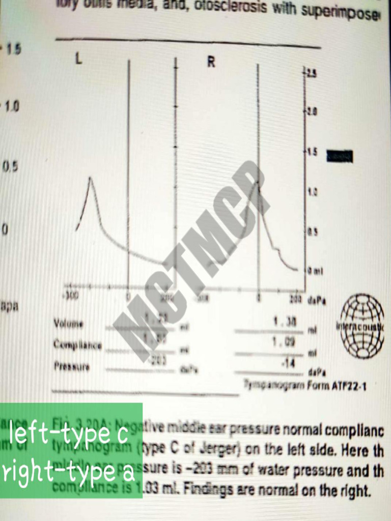 ENT Charts Tympanometry | PDF