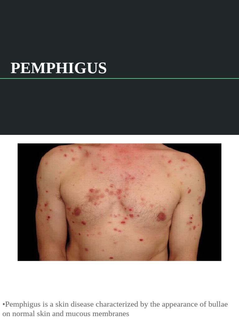PEMPHIGUS | PDF