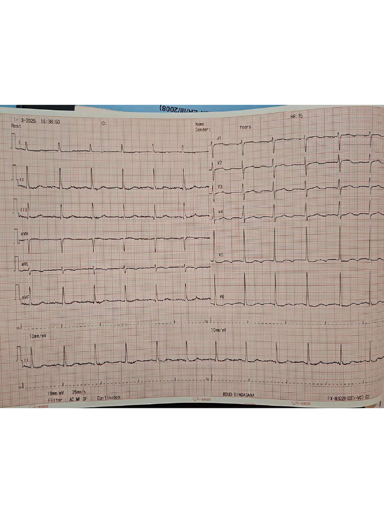 EKG | PDF