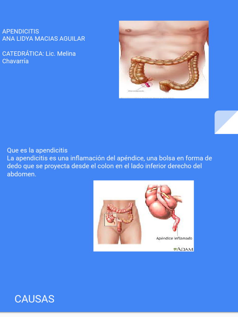 Apendicitis | PDF
