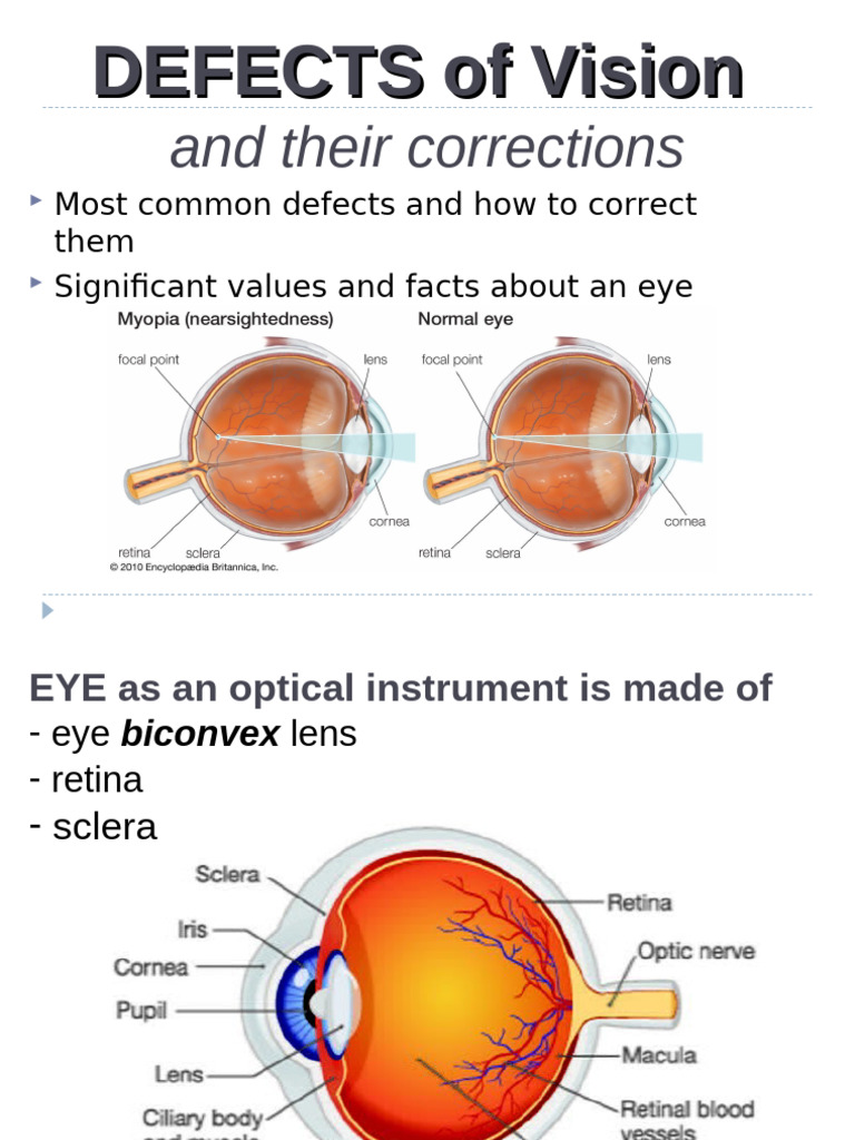 Vision defects | PDF | Eye | Visual System