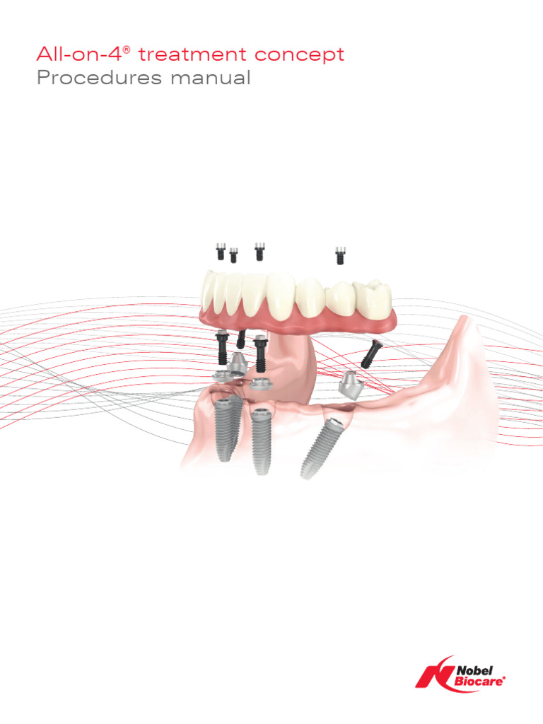 All-On-4 Treatment Concept Manual US - 79360 C | PDF | Dental Implant ...