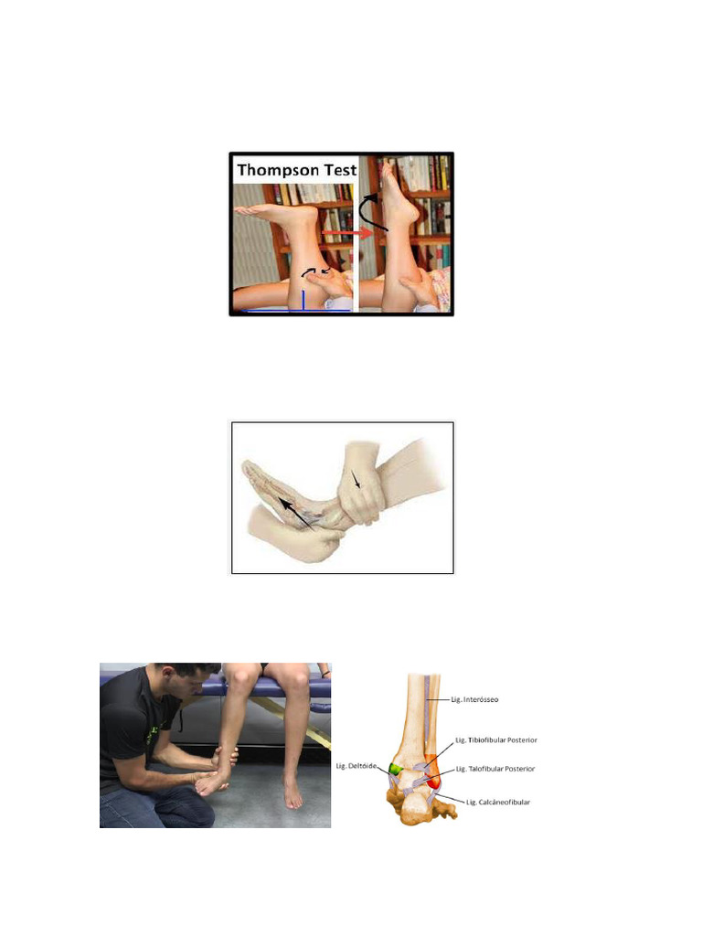 Teste de Kleiger e Lesões Ligamentares | PDF