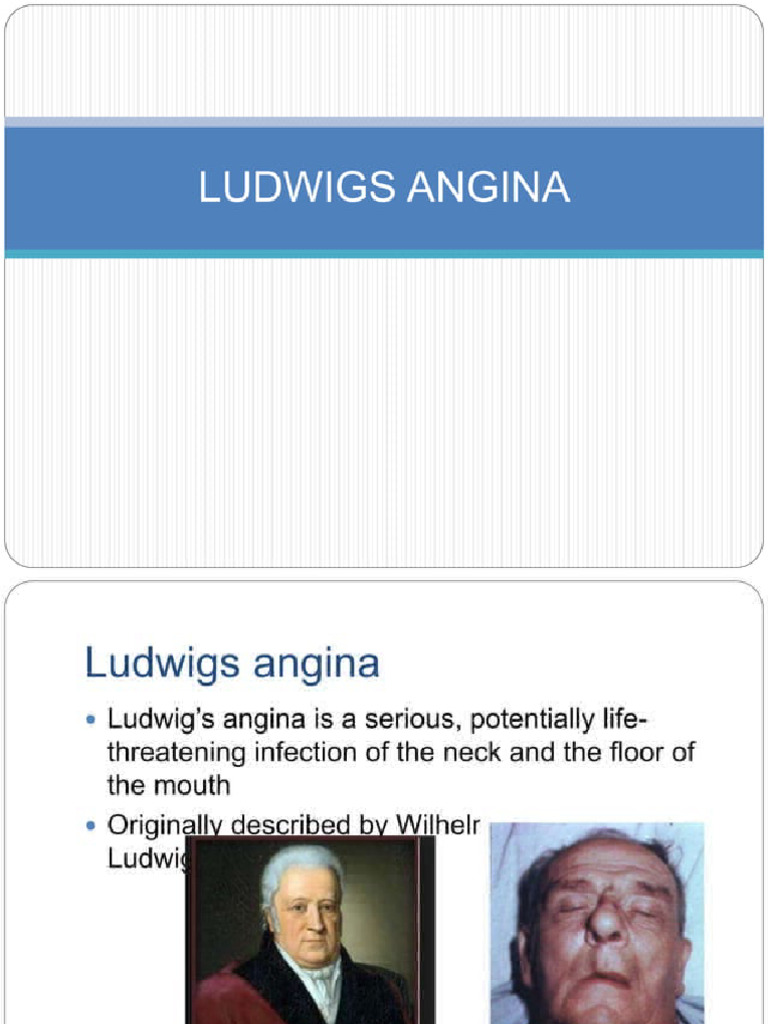 Ludwig Angina | PDF