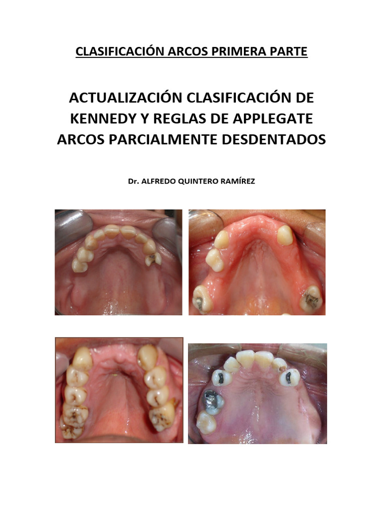 Clasificación de Arcos Parcialmente Desdentados | PDF | Diente