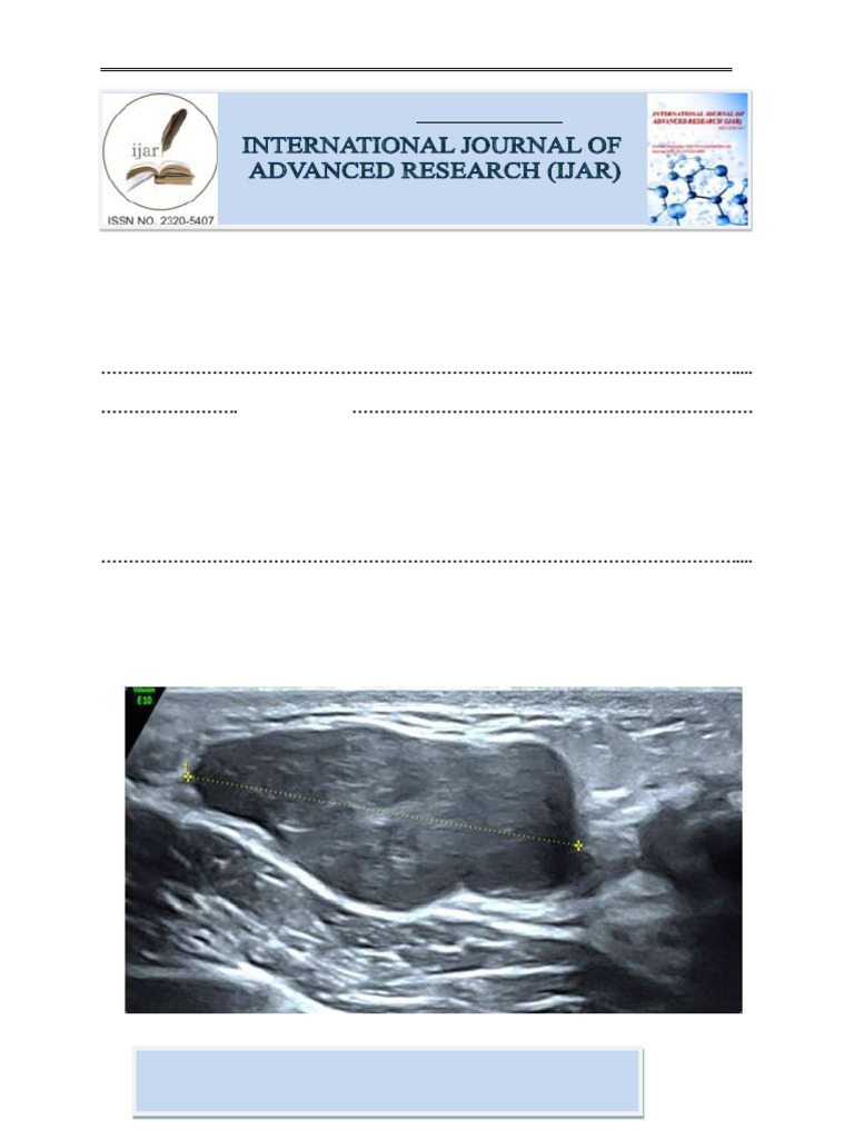 Pseudoangiomatous Stromal Hyperplasia (Pash) of The Breast: A Report of ...
