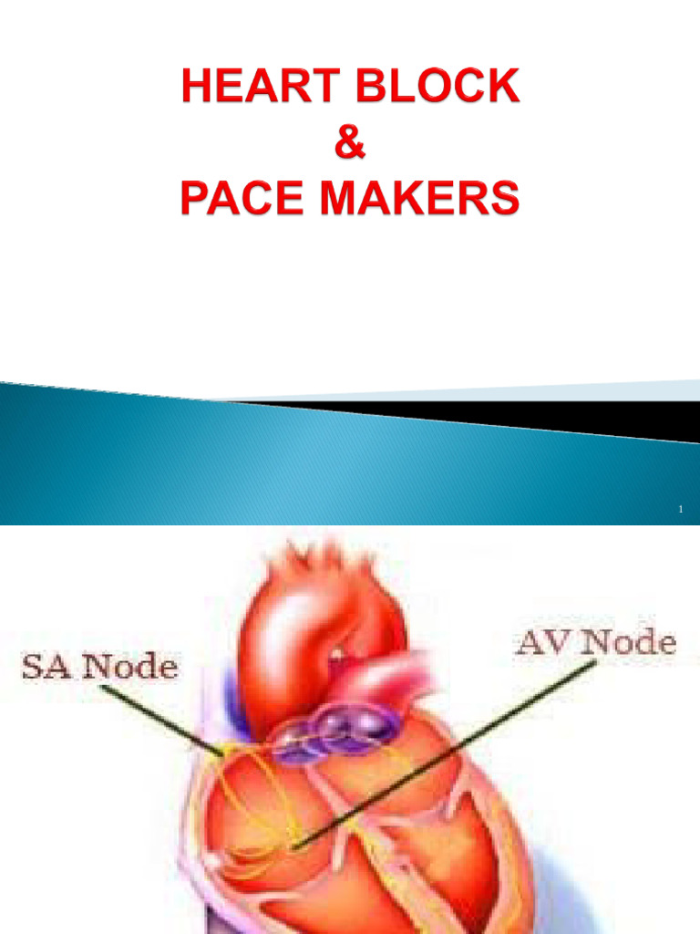 Understanding Atrioventricular Block Types | PDF | Artificial Cardiac ...