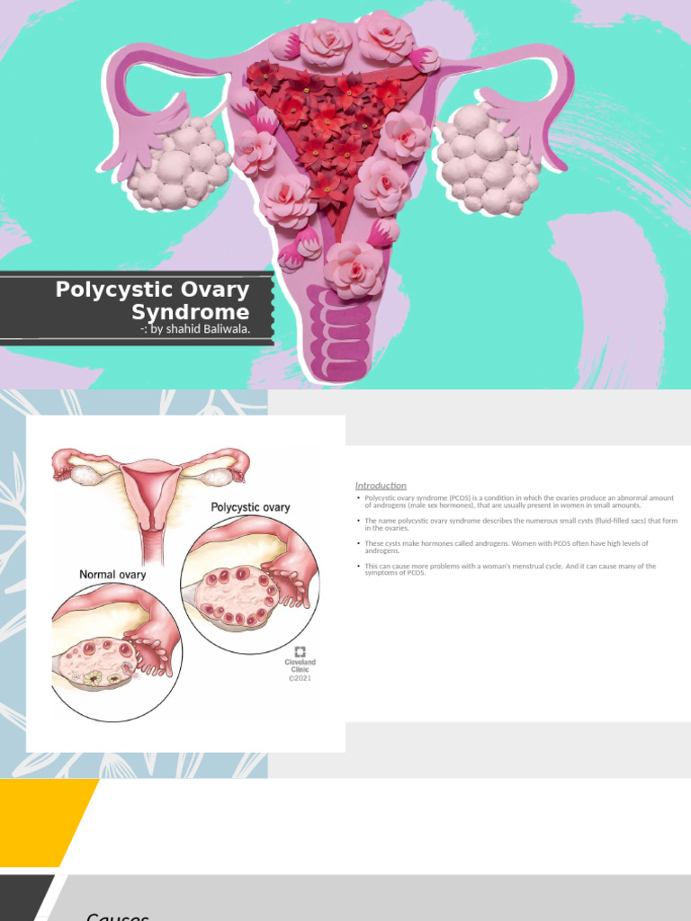 Polycystic Ovary Syndrome (By Shahid) | PDF | Polycystic Ovary Syndrome ...