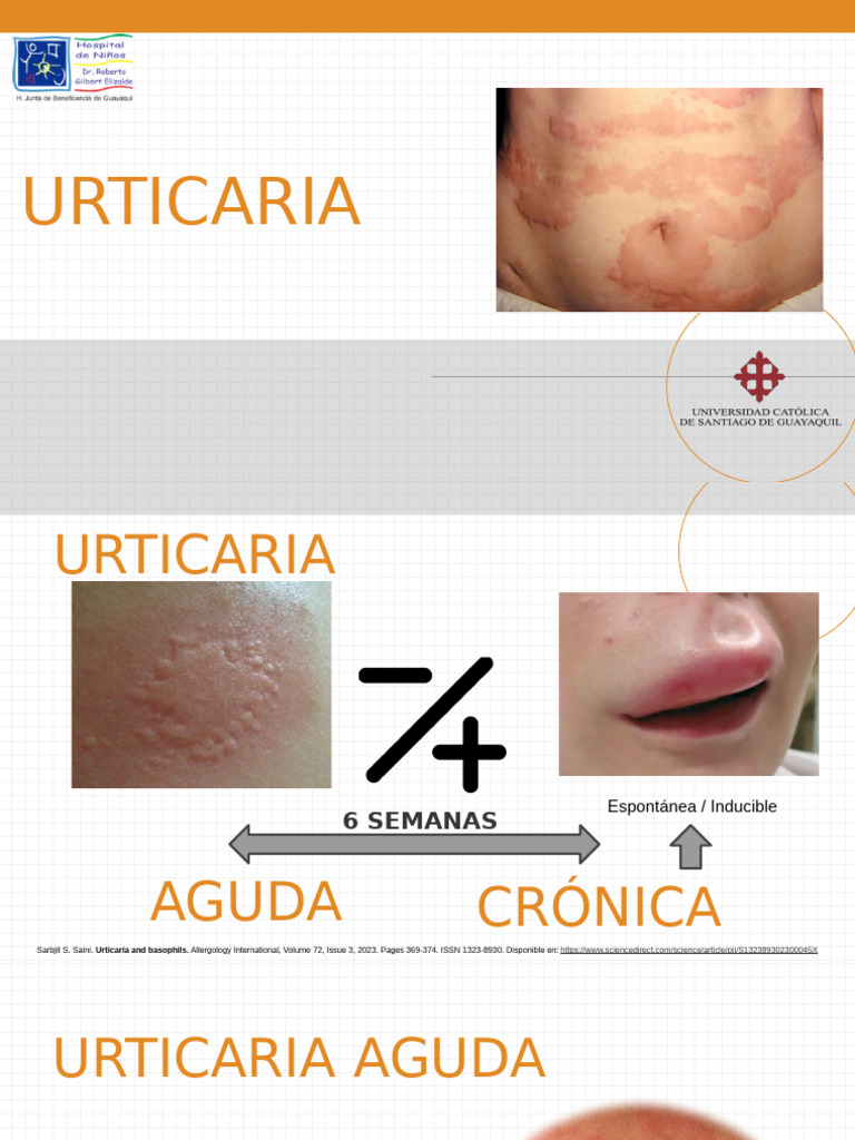 Urticaria | PDF | Especialidades Medicas | Inmunología
