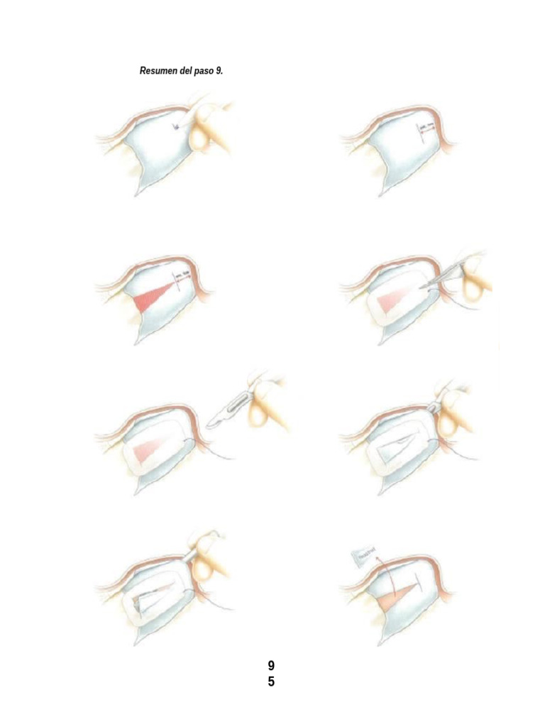 Técnica de Teorrinoplastia: Corte Alto | PDF | Hueso | Nariz humana