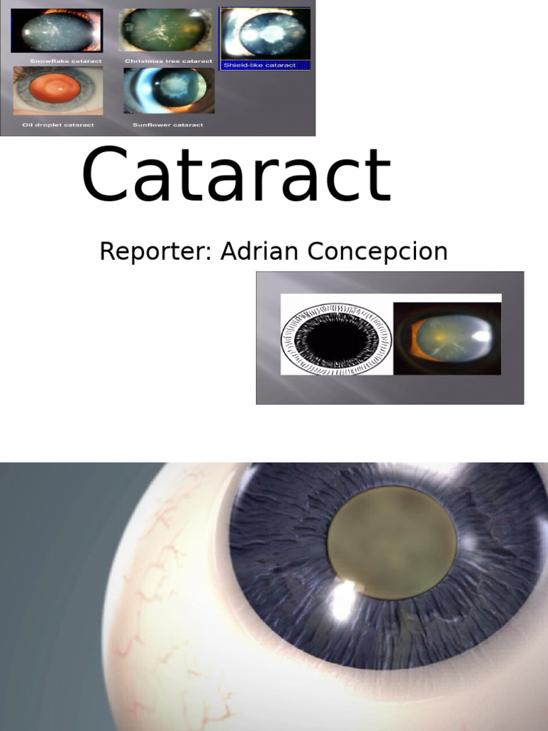 Understanding Cataracts: Causes & Treatment | PDF