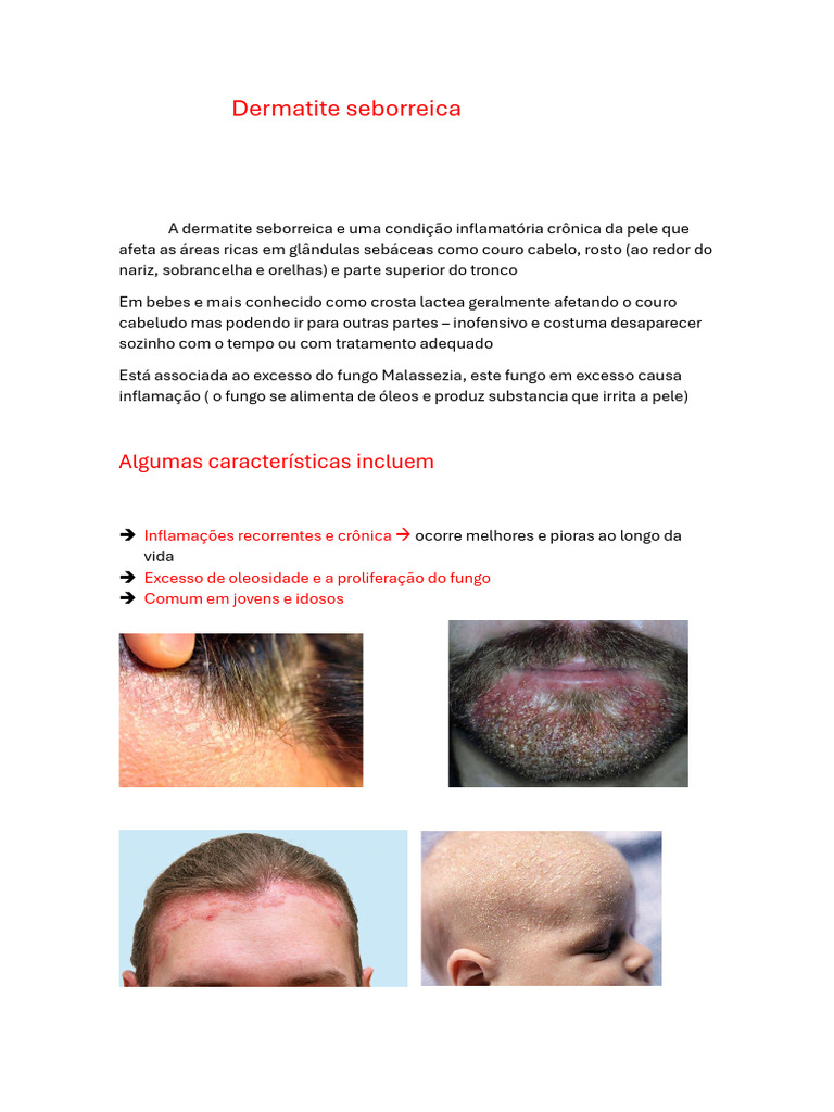 Dermatite seborreica ( leonara) | PDF
